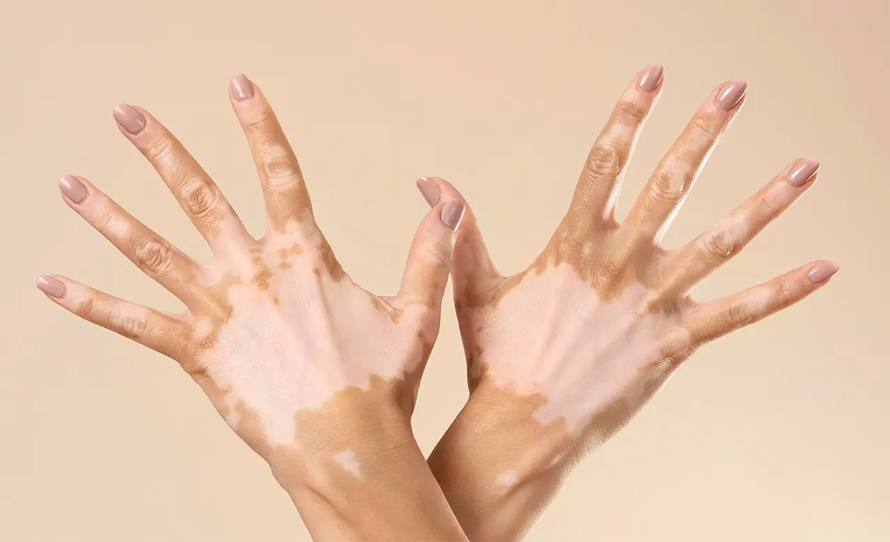 Vitiligo Early Signs Symptoms And Causes